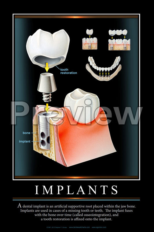 Implants #2 Wall Chart – Dental Flip Charts by Stephen F. Gordon