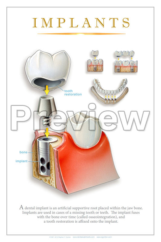 Implants #2 Wall Chart – Dental Flip Charts by Stephen F. Gordon