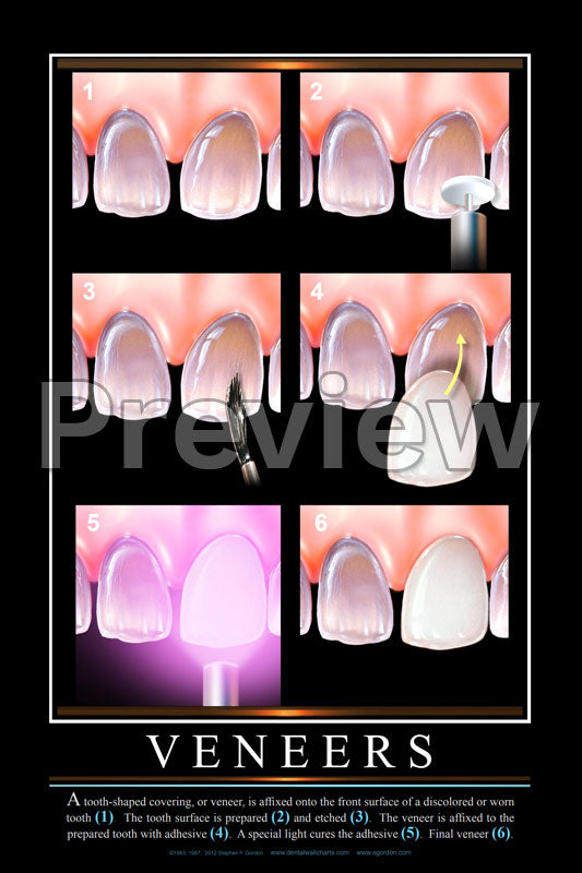 Veneers Wall Chart – Dental Flip Charts by Stephen F. Gordon