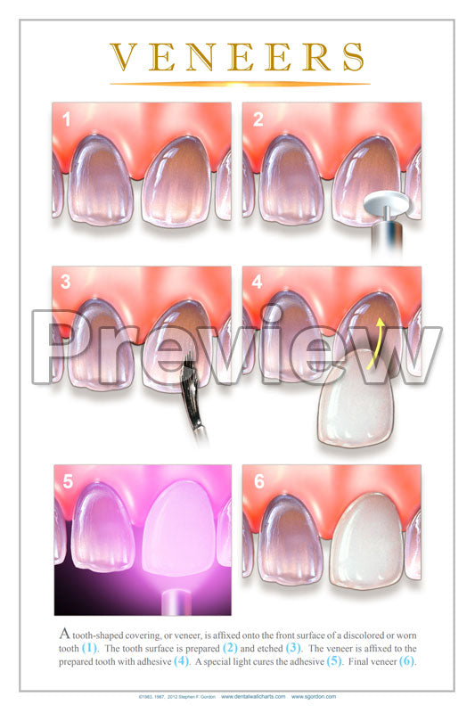 Veneers Wall Chart – Dental Flip Charts by Stephen F. Gordon