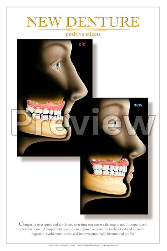 New Denture Wall Chart – Dental Flip Charts by Stephen F. Gordon