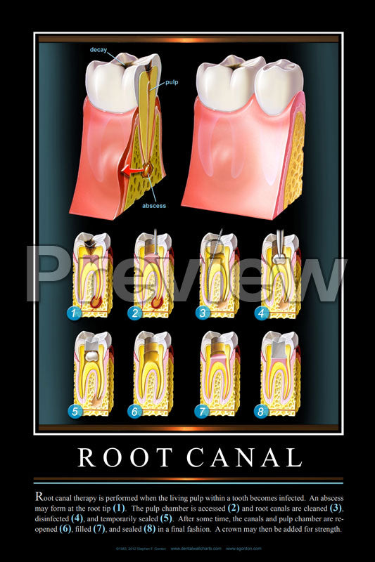Root Canal Wall Chart – Dental Flip Charts by Stephen F. Gordon