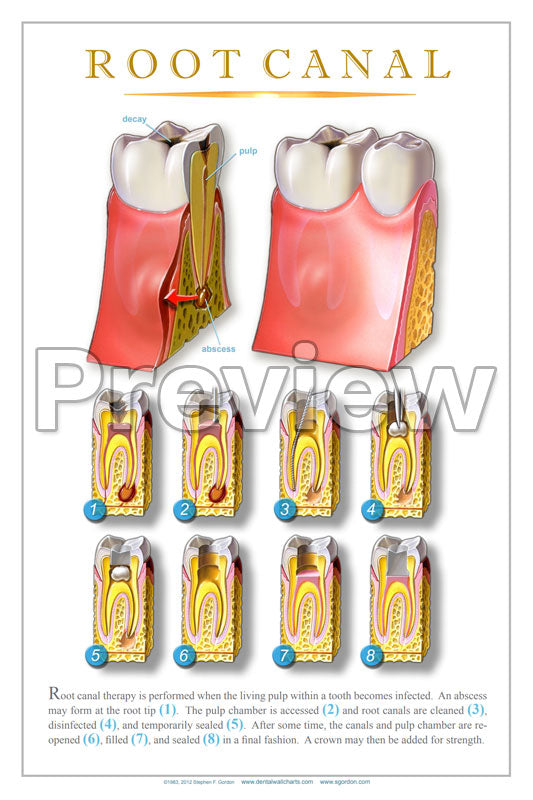 Root Canal Wall Chart – Dental Flip Charts by Stephen F. Gordon